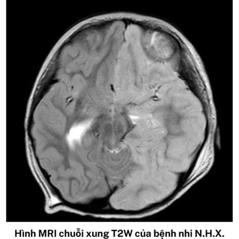 BV Nhi đồng cứu trẻ nguy kịch do bệnh não cấp hiếm gặp