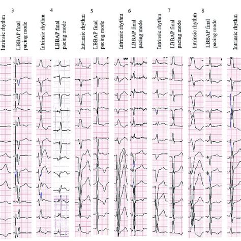 One Beat Of Intrinsic Rhythm With Left Bundle Branch Block Lbbb And 1