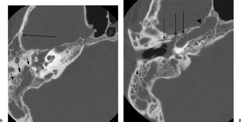 Temporal Bone Trauma Radiology Key