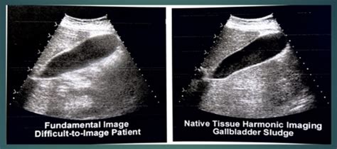 Chapter 17 Harmonics And Contrast Agents Quiz 9 Flashcards Quizlet