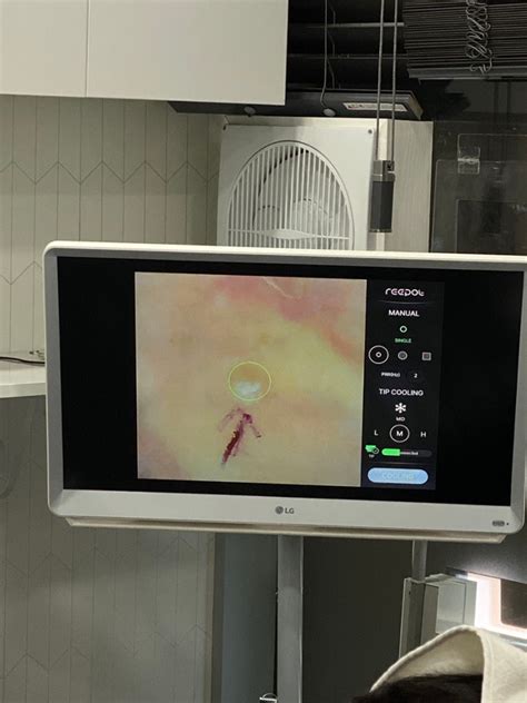 리팟레이저 부작용 없이 손등 검버섯 얼굴 흑자 제거 후기 비용 가격 효과 네이버 블로그