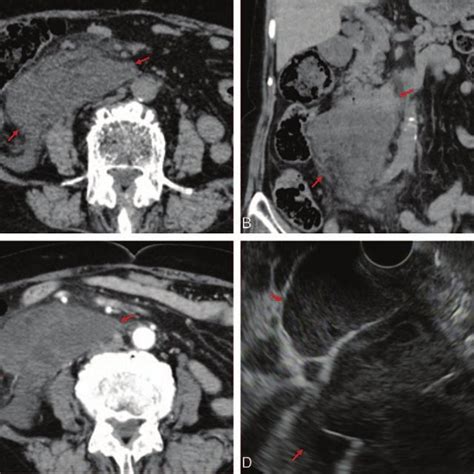 Eus Guided Idiopathic Retroperitoneal Abscess Drainage With Internal