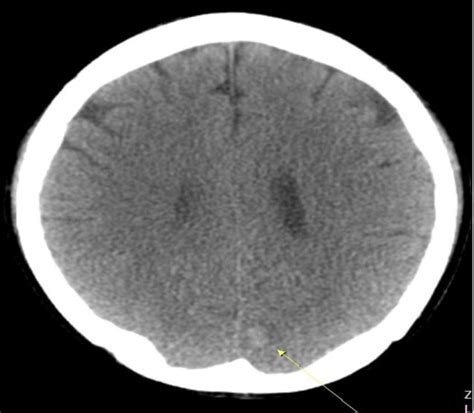Pdf Superior Mesenteric Artery Occlusion Caused By Infective