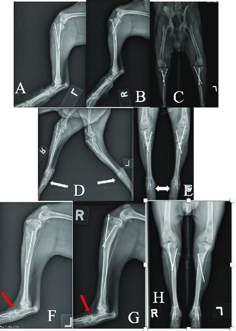 Development Of Diffuse Osteopenia Of The Tarsus And Metatarsus After A