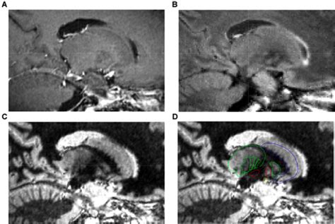 Fgatir New Scan For Surgical Targeting Movement Disorders And Neurorestoration Program Norman