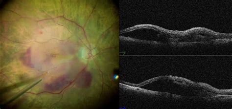 Retinal Detachment Oct