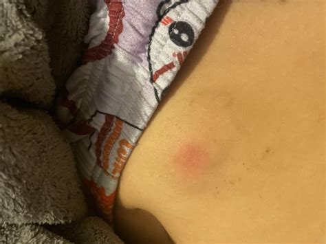 Omnipod Infection R Type1diabetes