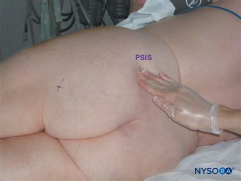 Sciatic Nerve Block Landmarks And Nerve Stimulator Technique Nysora