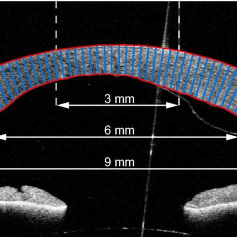 Single Image B Scan From An AS OCT Scan Showing The Cornea And The Download Scientific