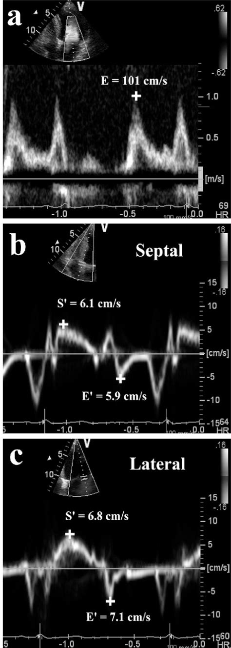 Figure 1 From A New Tissue Doppler Index In Predicting Future Atrial Fibrillation In Patients