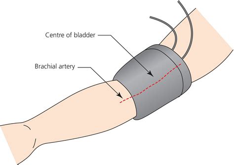 Blood Pressure Measurement Thoracic Key