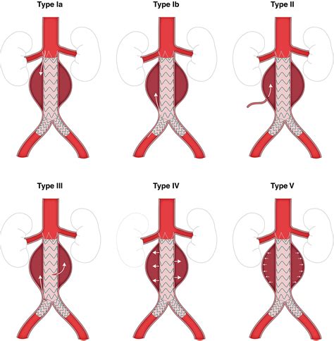 2022 Acc Aha Guideline For The Diagnosis And Management Of Aortic