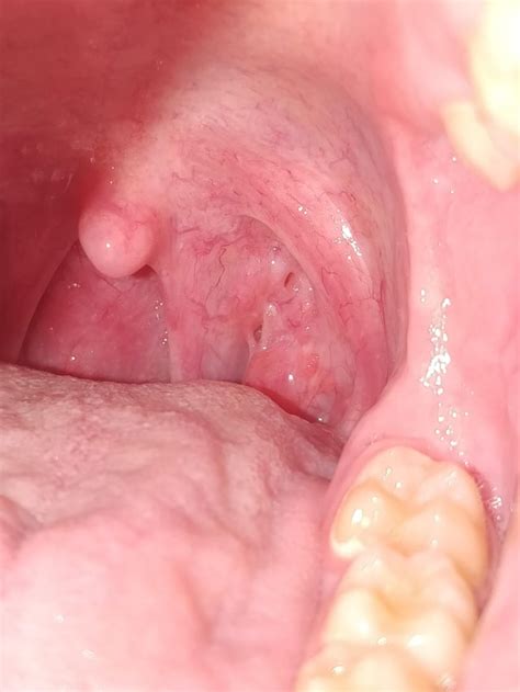 Is This A Tonsil Cyst Raskdocs