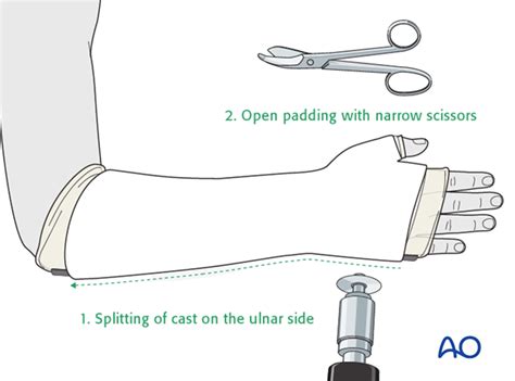 Short Or Long Arm Cast For Simple Epiphysiolysis Salter Harris I Both