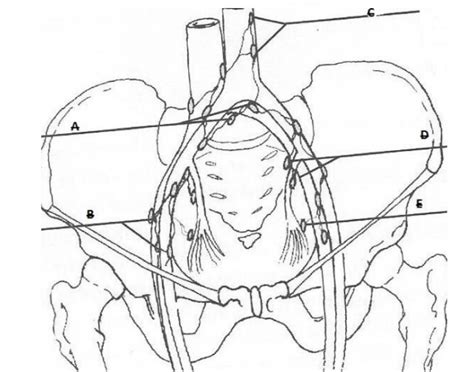 Pelvic Lymph Nodes Quiz