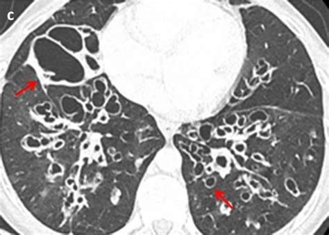 Bronchiectasis In Primary Ciliary Dyskinesia Radiological Keys For Its