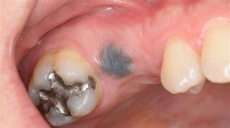 Amalgam Tattoo A Grey Blue Stain Near Old Fillings Artsmiles