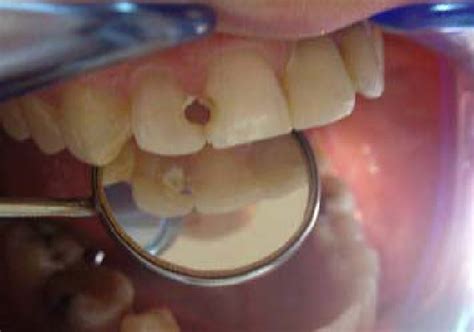 Figure 4 From Whitening Non Vital Teeth A Case Report Semantic Scholar