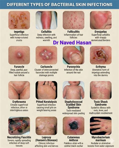 Bacterial Skin Infections Key Lesion Patterns Dr Naved Hasan Posted