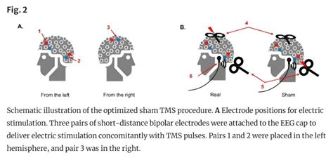 Jali Medical Inc On Linkedin Tms Eeg Tmseeg Brainstimulation Brainresearch Neuromodulation…