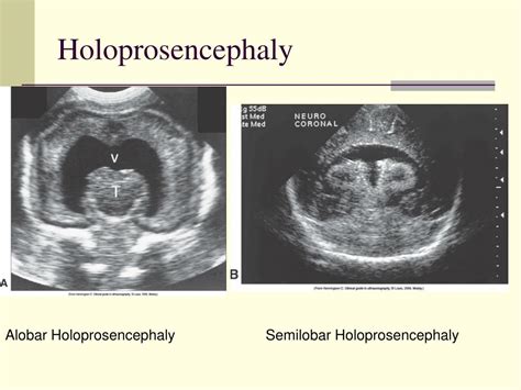 Ppt Neonatal Echoencephalography Powerpoint Presentation Free Download Id5519290
