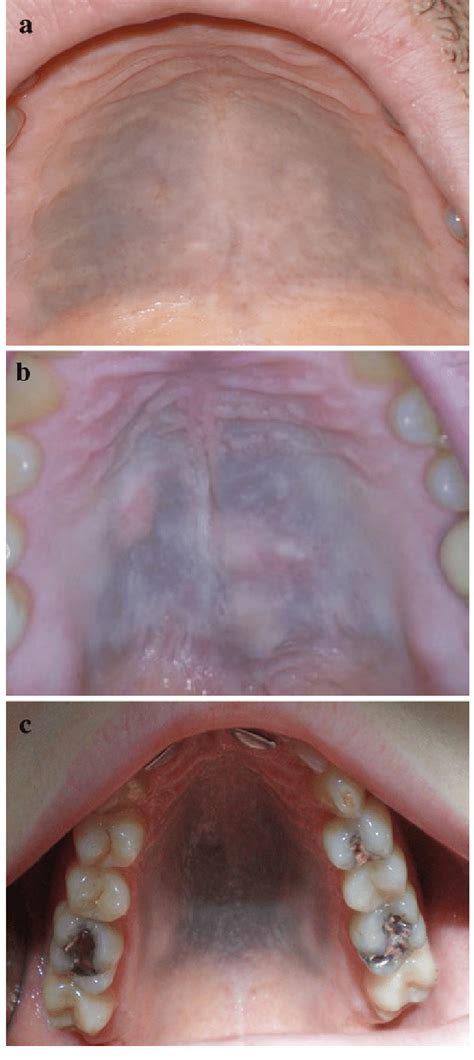 Diffuse Grey Blue Macular Pigmentation On Of The Hard Palatal Mucosa Download Scientific