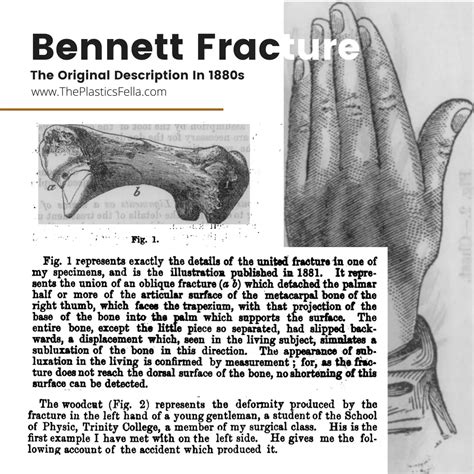 Bennett Fracture X Rays Diagnosis Treatment