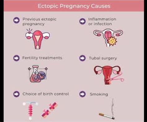 Causes Of Ectopic Pregnancy Medizzy