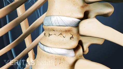 Types Of Spinal Compression Fractures