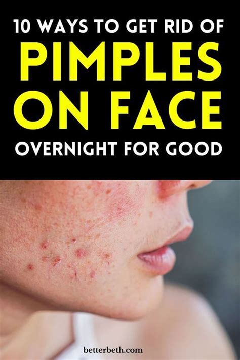 How To Get Rid Of Pimples Overnight Effective Ways Artofit