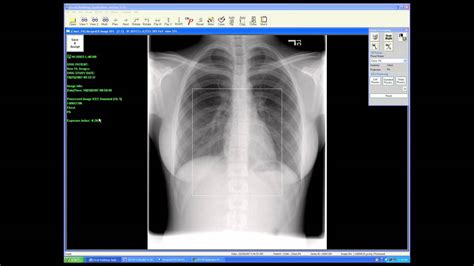 Chest X Ray Xray Exposure At Eliza Coles Blog Chest X Ray Xray Exposure At Eliza Coles Blog