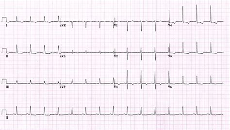 Sine Wave Pattern Arrhythmia And Sudden Paralysis That Result From Severe Hyperkalemia Circulation