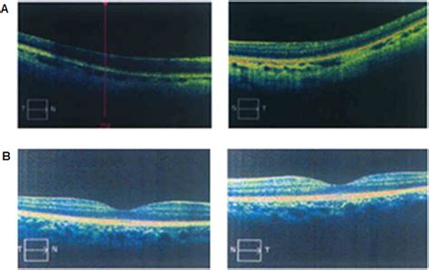 Photographs Of Oct Examination Compared With A Normal Control B The