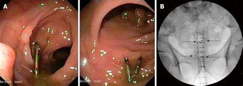 Evaluating Long Term Attachment Of Two Different Endoclips In The Human