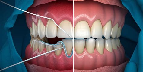 Flap Surgery In Ryde Nsw Advanced Gum Treatment