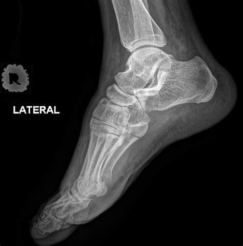 Closed Fracture Of Right 5th Proximal Metatarsal Uni Clinic