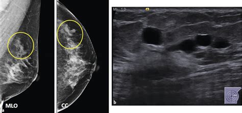 11 Breast Anatomy Thoracic Key