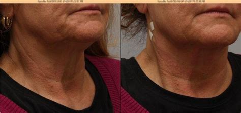 Pdo Thread Lift Before And Afters Torrance And Palos Verdes Ca