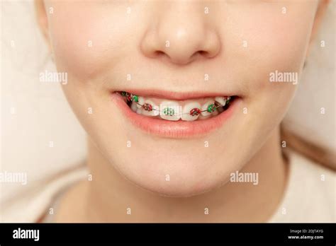 Green Braces For Teeth