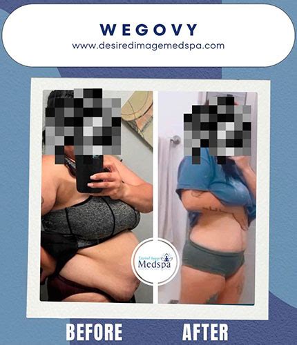 Wegovy Before And After Photos And Weight Loss Results