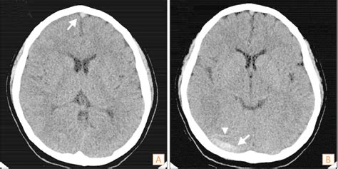 Brain Ct Findings The Ct Shows Hyperattenuation Segments At The Download Scientific Diagram