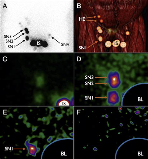Postexcision Confirmation Of Complete Sentinel Node SN Removal Download Scientific Diagram