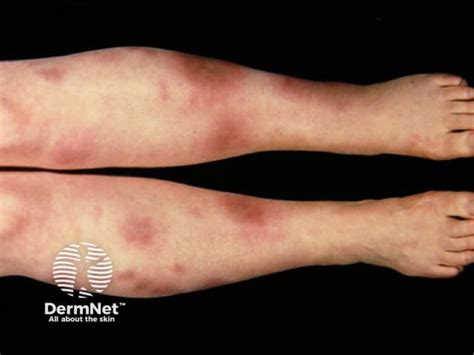 Erythema Nodosum Images