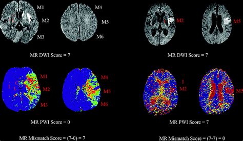 Rapid Assessment Of Perfusiondiffusion Mismatch Stroke