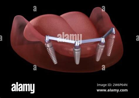 Removable Mandibular Prosthesis With Gum All On 4 System Supported By