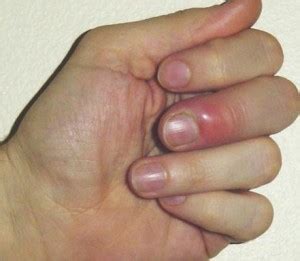Swollen Fingers Causes Symptoms And Treatment