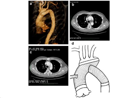 Postoperative Multidetector Computed Tomography Mdct Showing Total Download Scientific