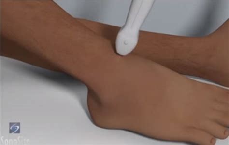 Foot And Ankle Extensor Tendon Transducer Position Graphic Sonosite Institute For Point Of Care