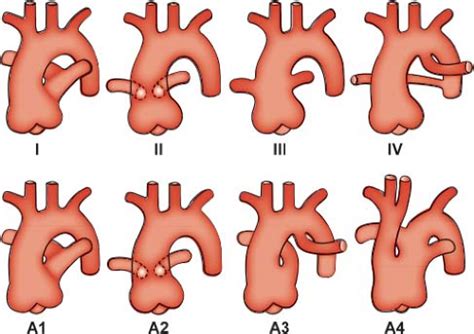 Truncus Arteriosus Thoracic Key