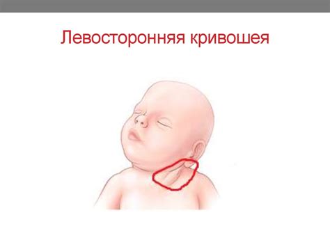 Массаж и гимнастика при врожденной мышечной кривошее презентация онлайн